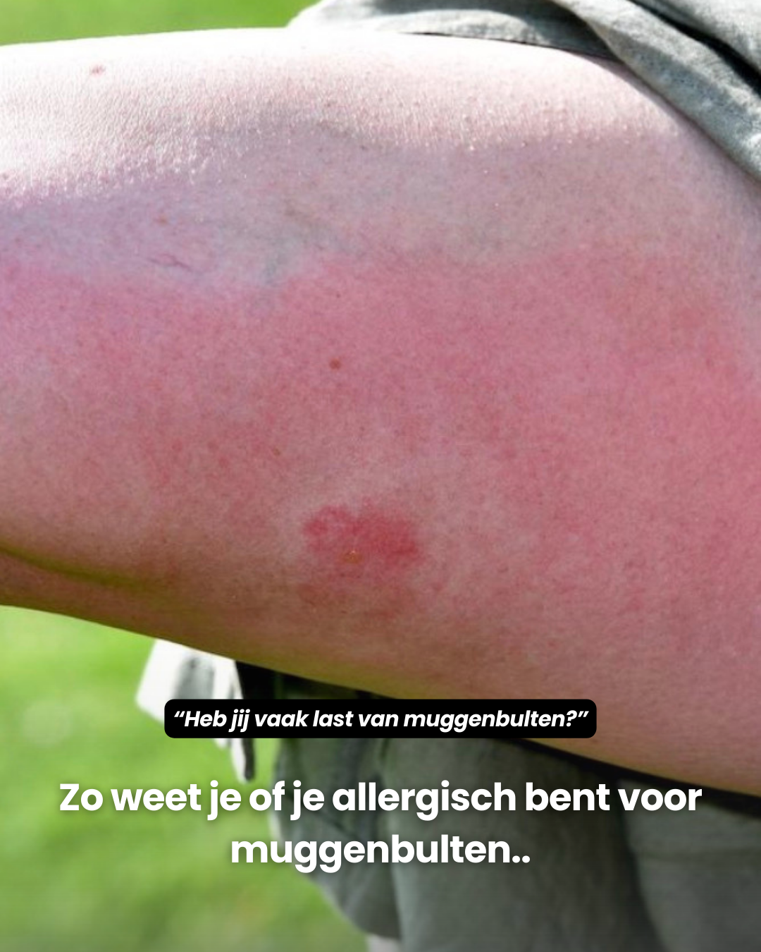 Zo weet je of je allergisch bent voor muggenbulten..